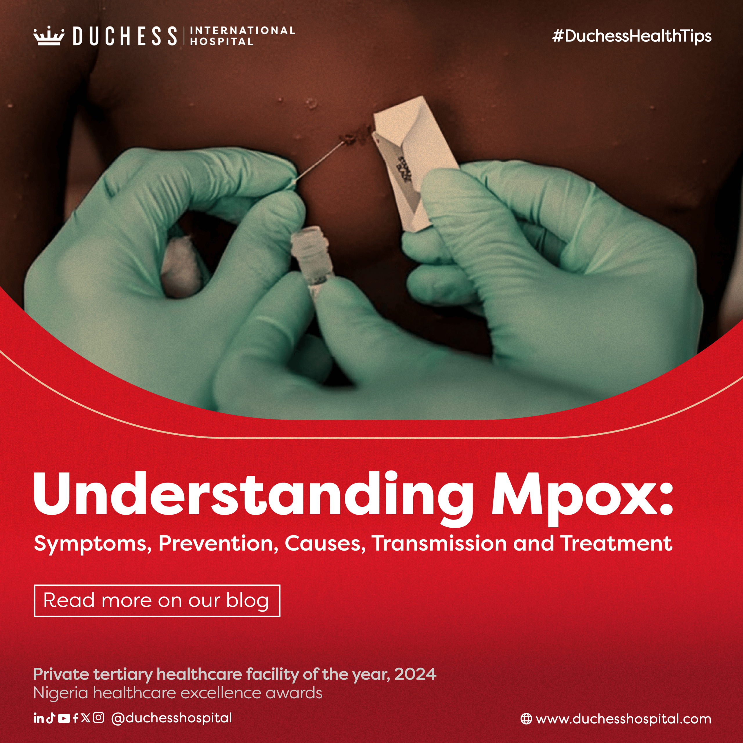 Understanding Mpox - Symptoms, Prevention, Causes, Transmission and ...